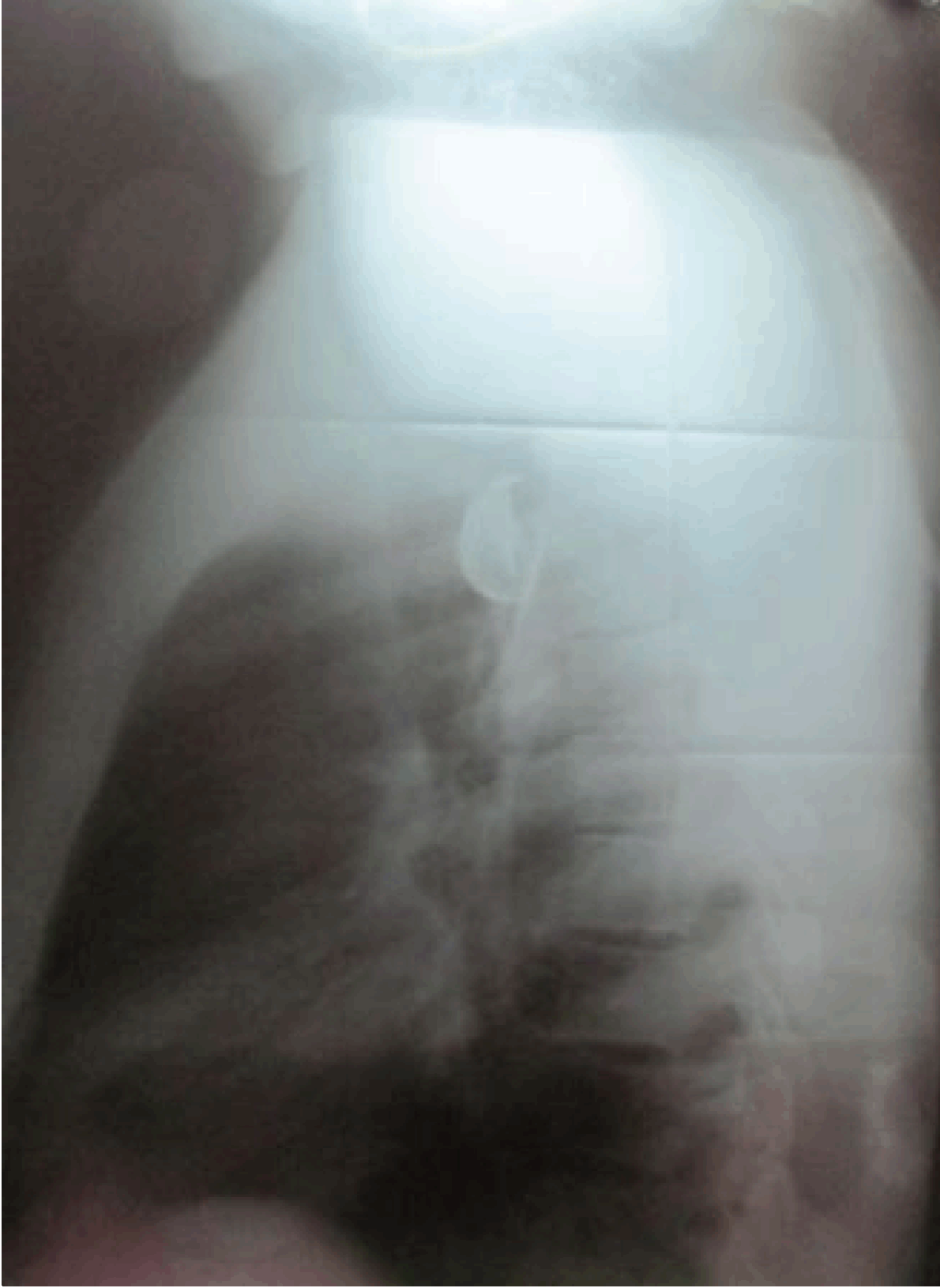 FULL TEXT - Surgical management of an impacted sharp metallic foreign ...