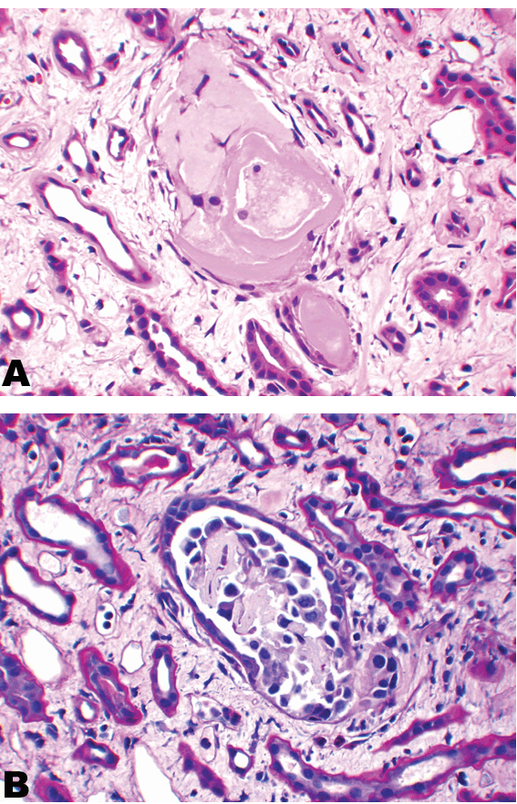FULL TEXT - Dual causes of multiple myeloma - International Journal of ...